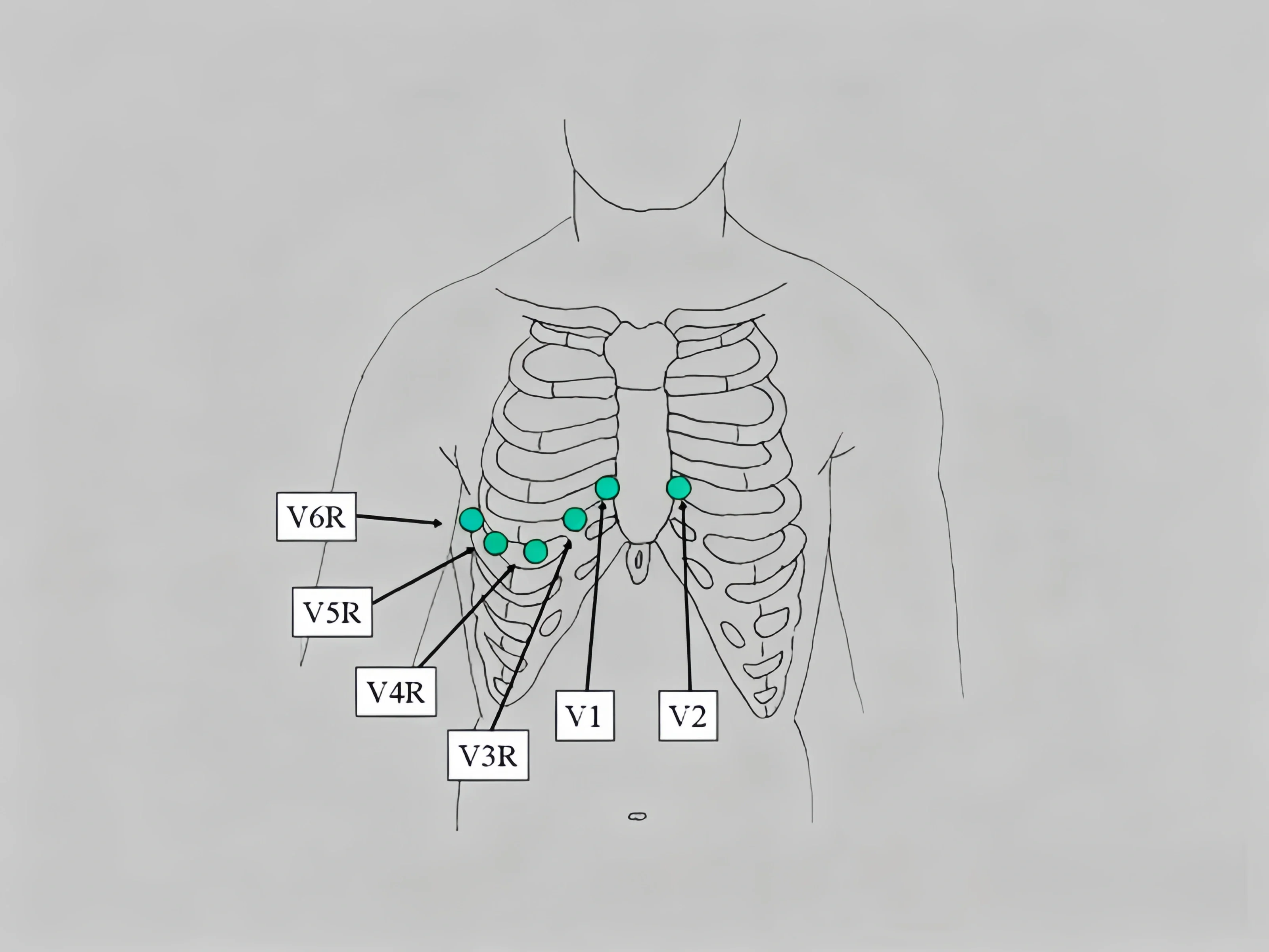Right Sided ECG Lead Placement: When and How to Use V4R | Critical Gui